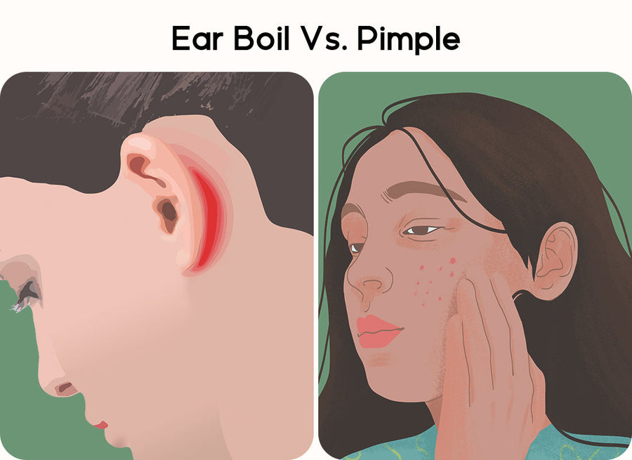 Ear Boil Vs. Pimple: What are the Differences? – Bebird